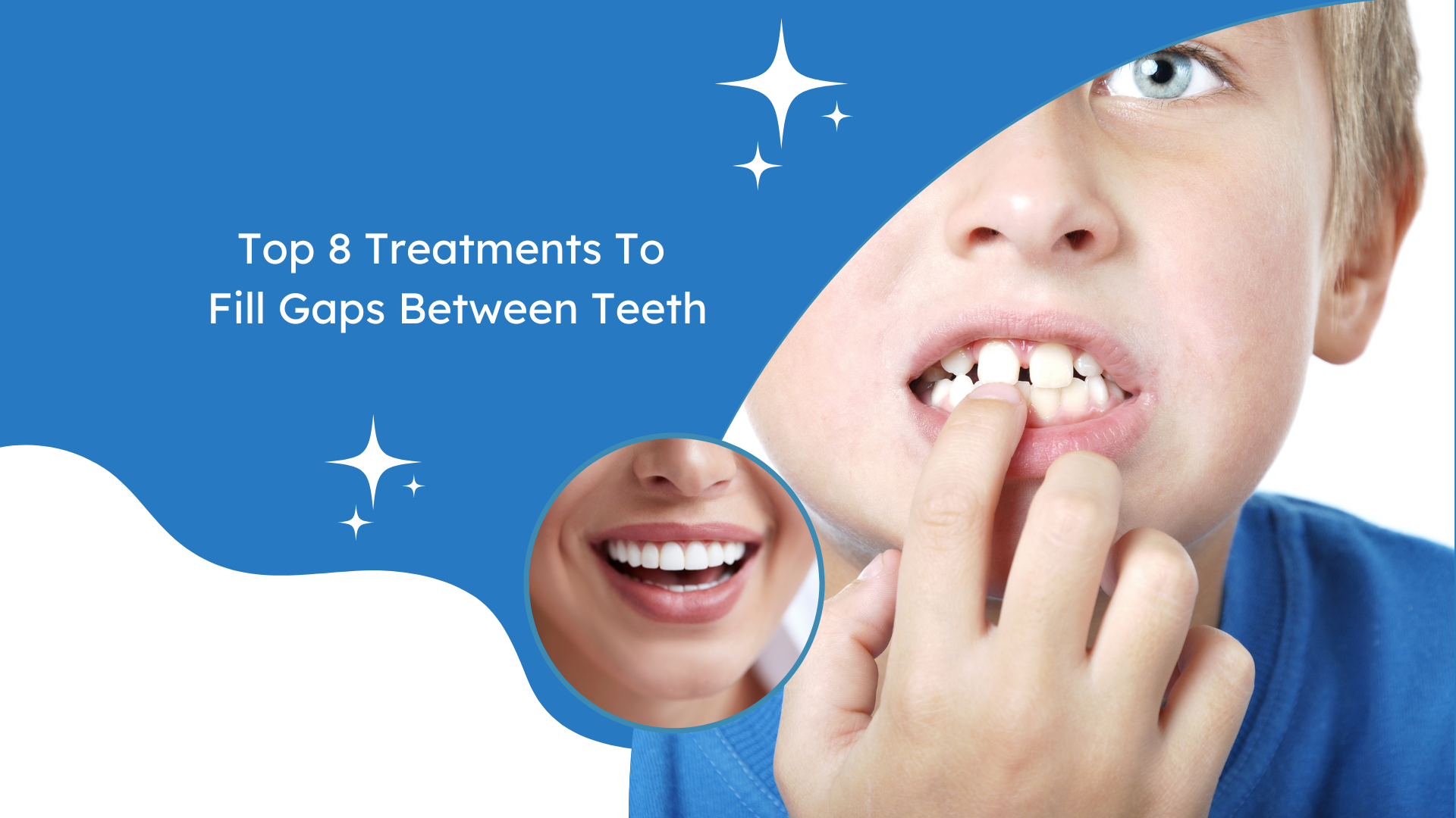 Treatments for gaps between teeth